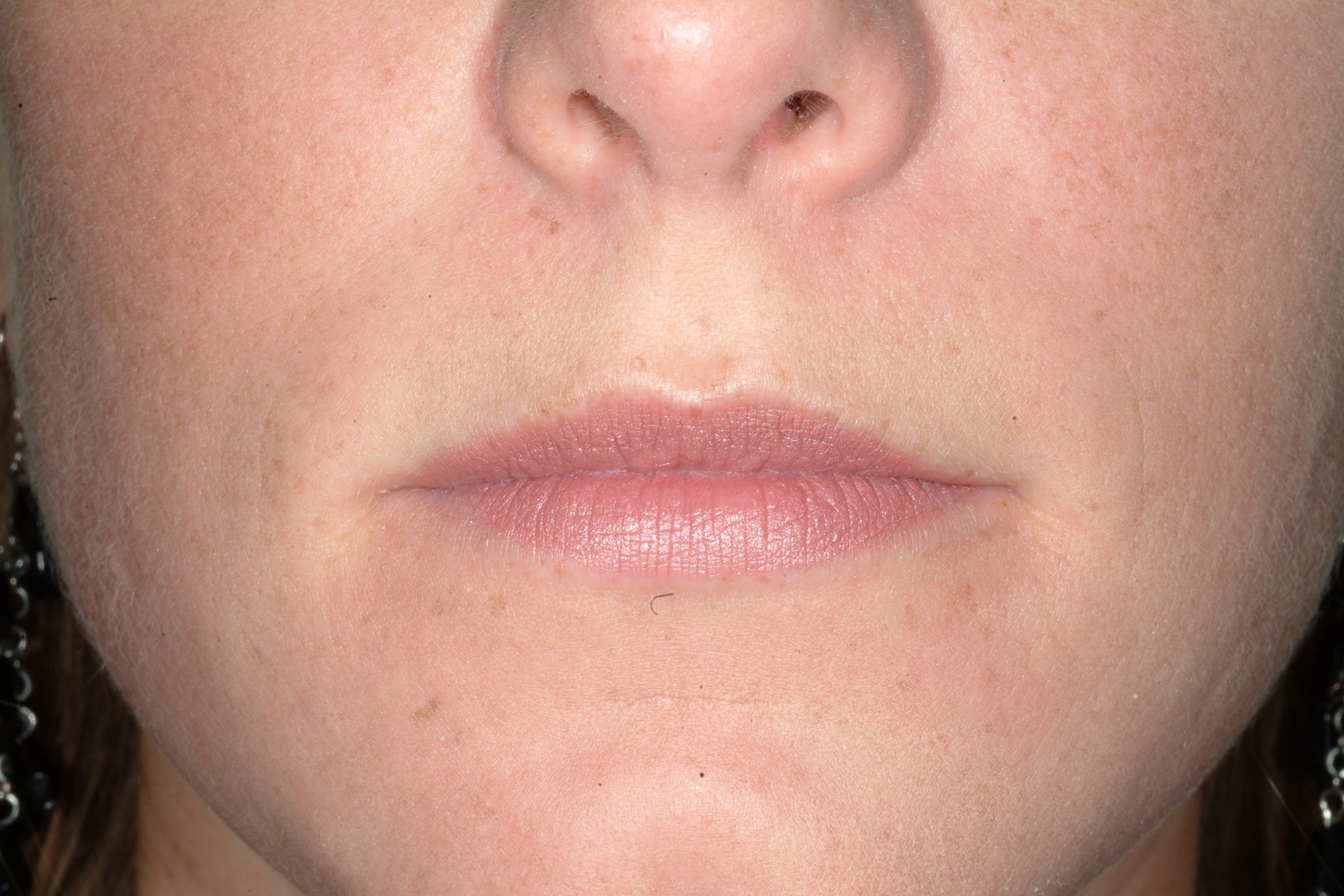 PermaLip|Lip enhancement|Lip augmentation